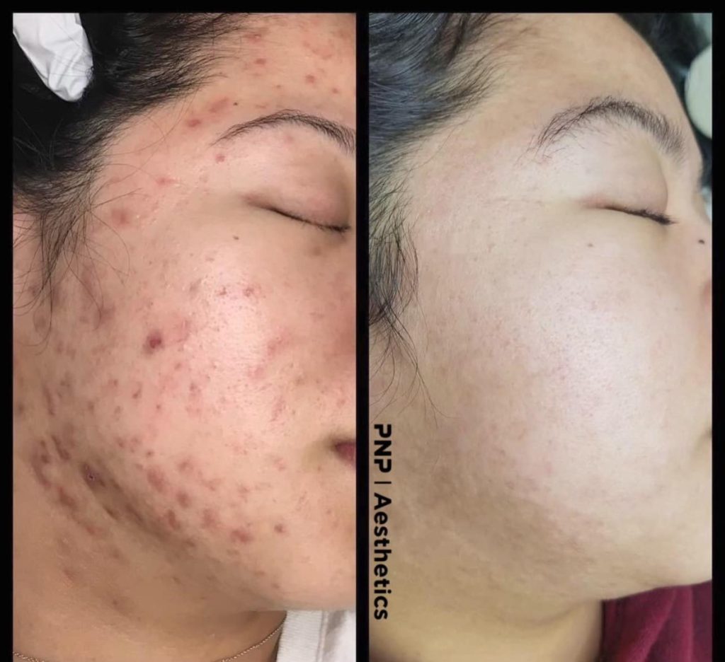 Điều trị da dầu mụn, lỗ chân lông to công nghệ Spectra-XT Laser - PNP Aesthetics